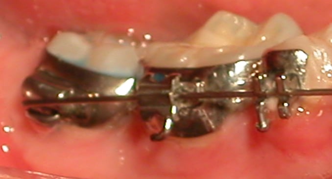 Top Orthodontic Finishing Mistakes to Avoid | A Guide by Dr. Jeffery Taylor