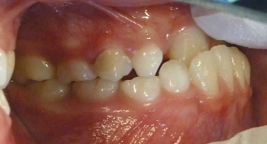 Clinical Analysis: Correcting Class III Malocclusions with Interceptive ...