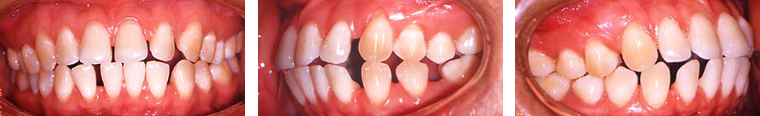 10 Simple Orthodontic Cases You Can Treat This Year