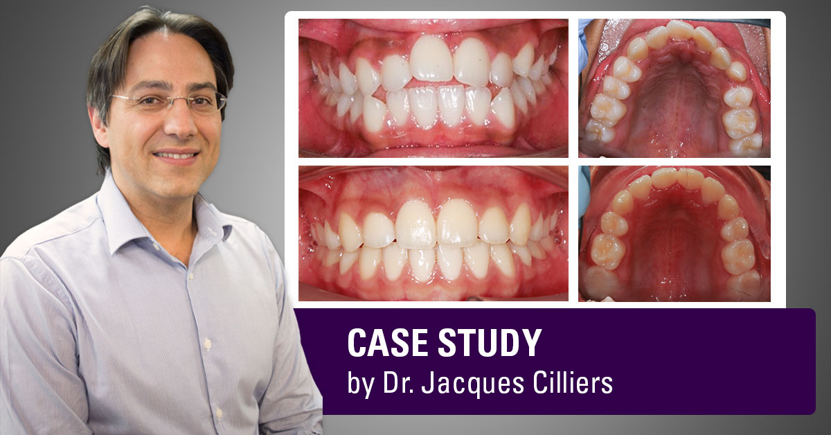 Case Study: How “Walking the Midline” Shifted this Patient’s Teeth and Confidence