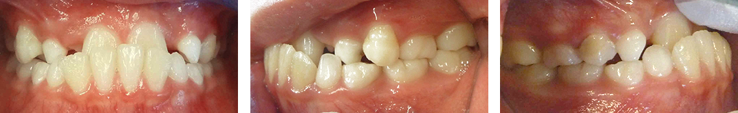 10 Simple Orthodontic Cases You Can Treat This Year