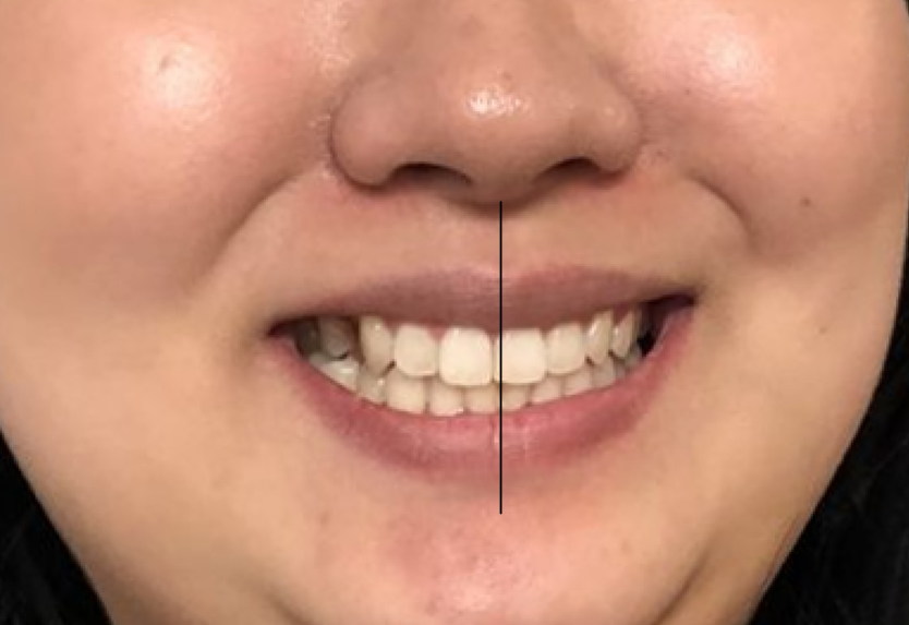 Myths & Facts About Midlines in Orthodontics | Dr. Jeffery Taylor sets ...