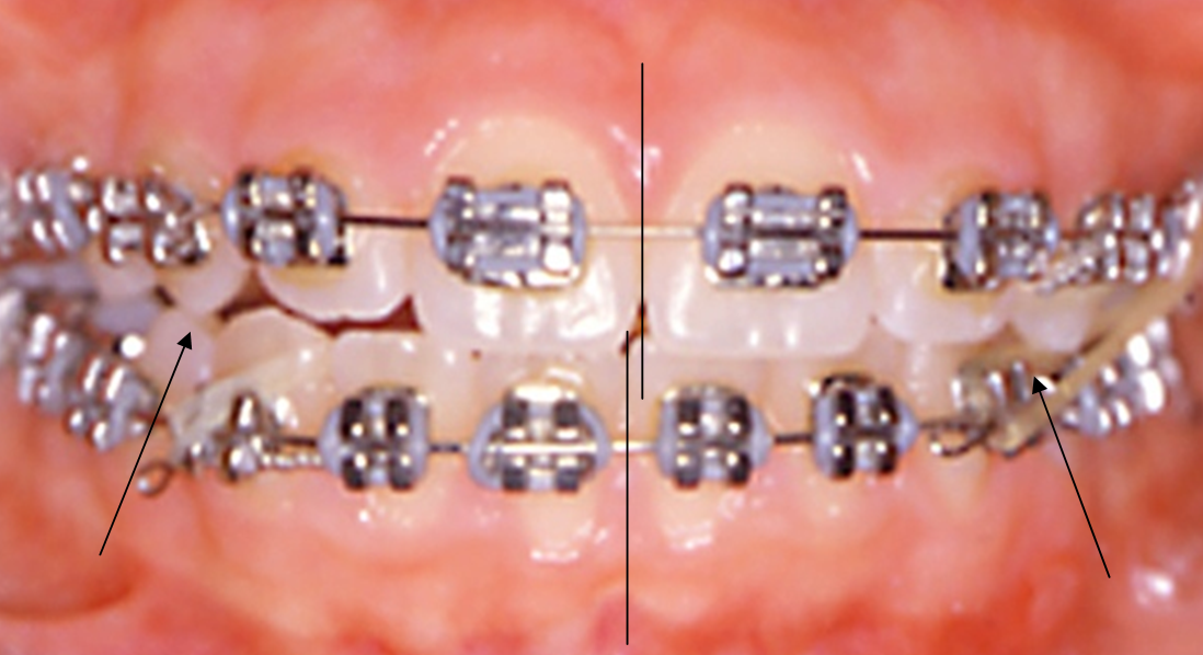 Myths & Facts About Midlines in Orthodontics | Dr. Jeffery Taylor sets ...