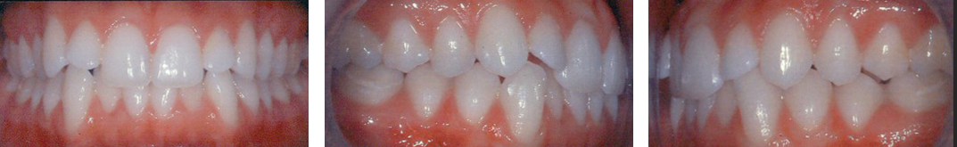 10 Simple Orthodontic Cases You Can Treat This Year