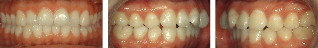 10 Simple Orthodontic Cases You Can Treat This Year