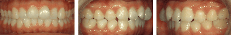 10 Simple Orthodontic Cases You Can Treat This Year 10-simple-orthodontic-cases-you-can-treat-this-year